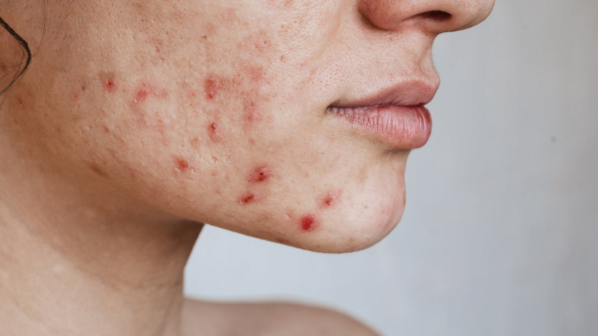 Espinillas: respondiendo a las preguntas más frecuentes | ARGANOUR